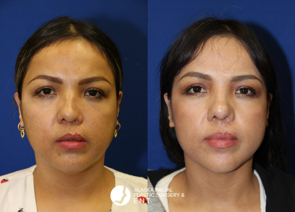 Cleft Rhinoplasty Before & Afters - Alaska Facial Plastic Surgery & ENT
