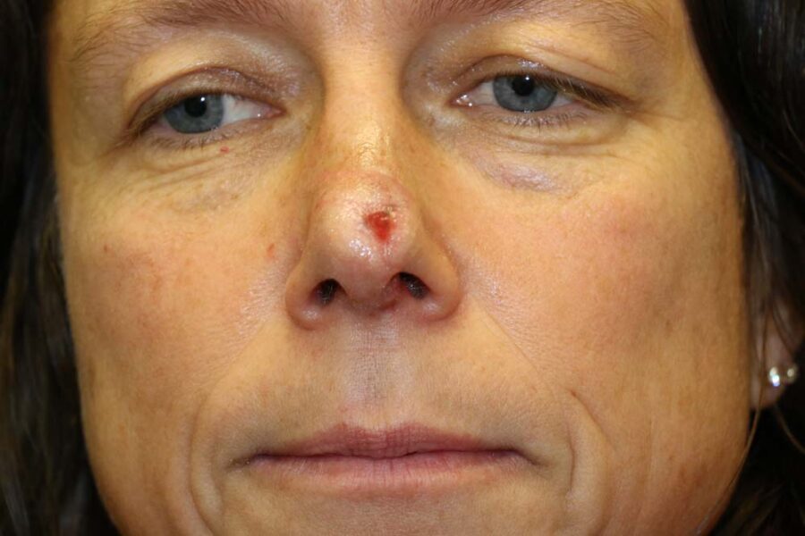 Skin Cancer & Facial Reconstruction 4 - Alaska Facial Plastic Surgery & ENT