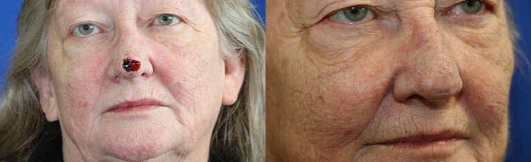 Skin Cancer & Facial Reconstruction Before & Afters - Alaska Facial ...
